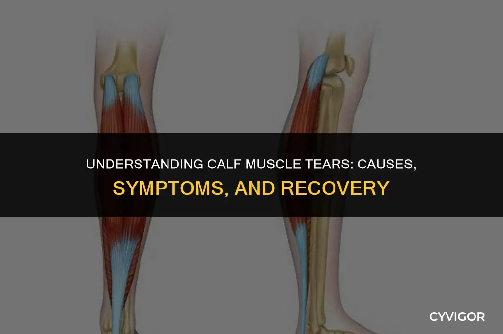 Understanding Calf Muscle Tears: Causes, Symptoms, And Recovery | CyVigor