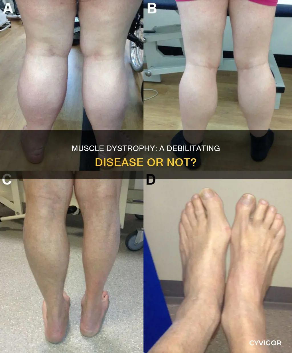 Muscle Dystrophy: A Debilitating Disease Or Not? | CyVigor