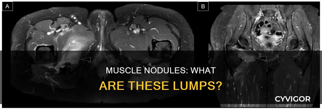 Muscle Nodules: What Are These Lumps? | CyVigor