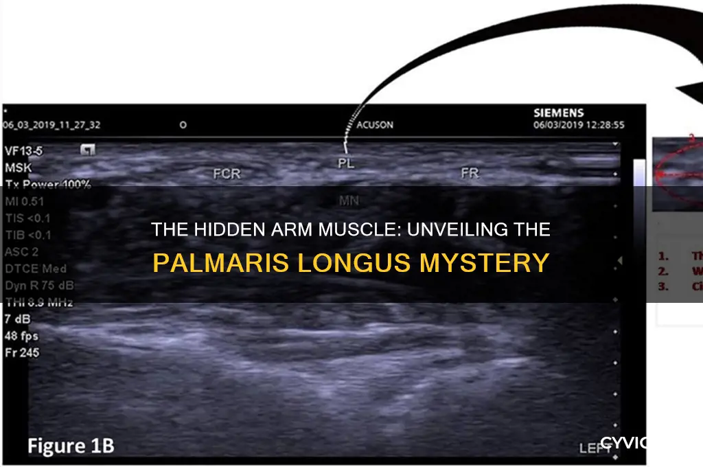 The Hidden Arm Muscle: Unveiling The Palmaris Longus Mystery | CyVigor