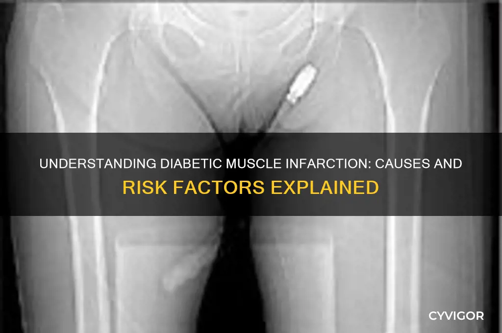 Understanding Diabetic Muscle Infarction: Causes And Risk Factors ...