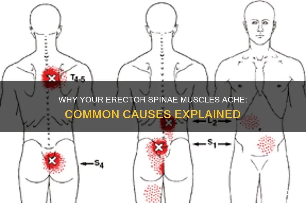 Why Your Erector Spinae Muscles Ache: Common Causes Explained | CyVigor