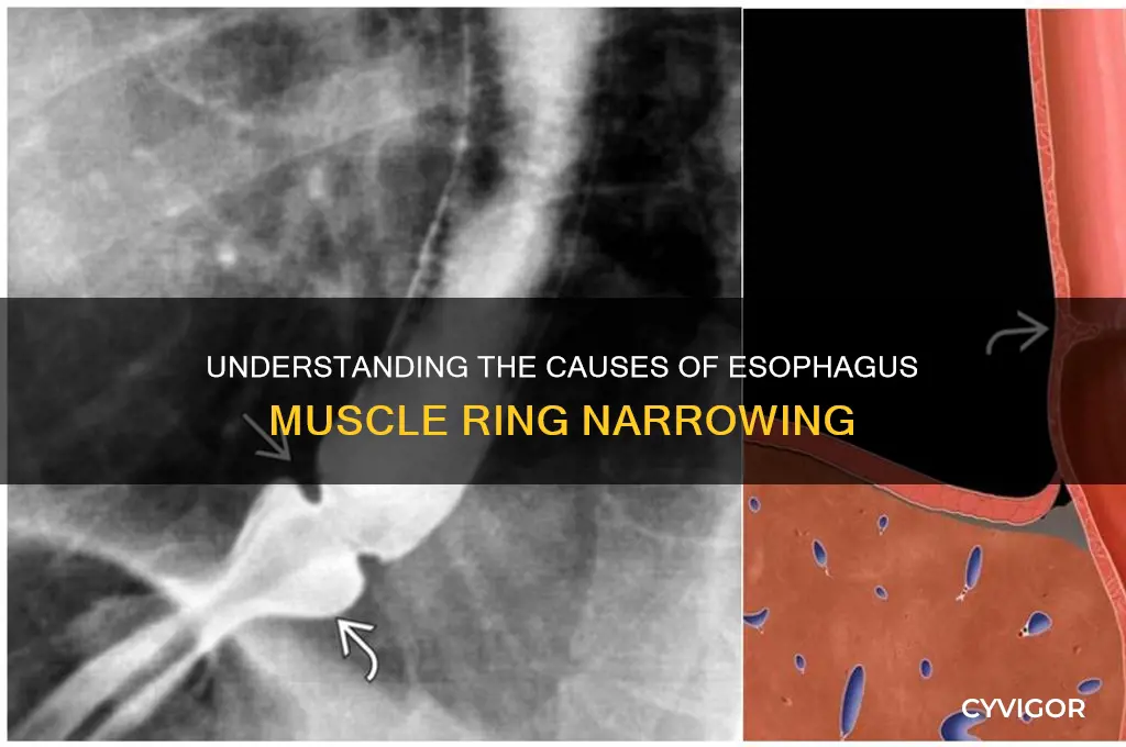 Understanding The Causes Of Esophagus Muscle Ring Narrowing | CyVigor