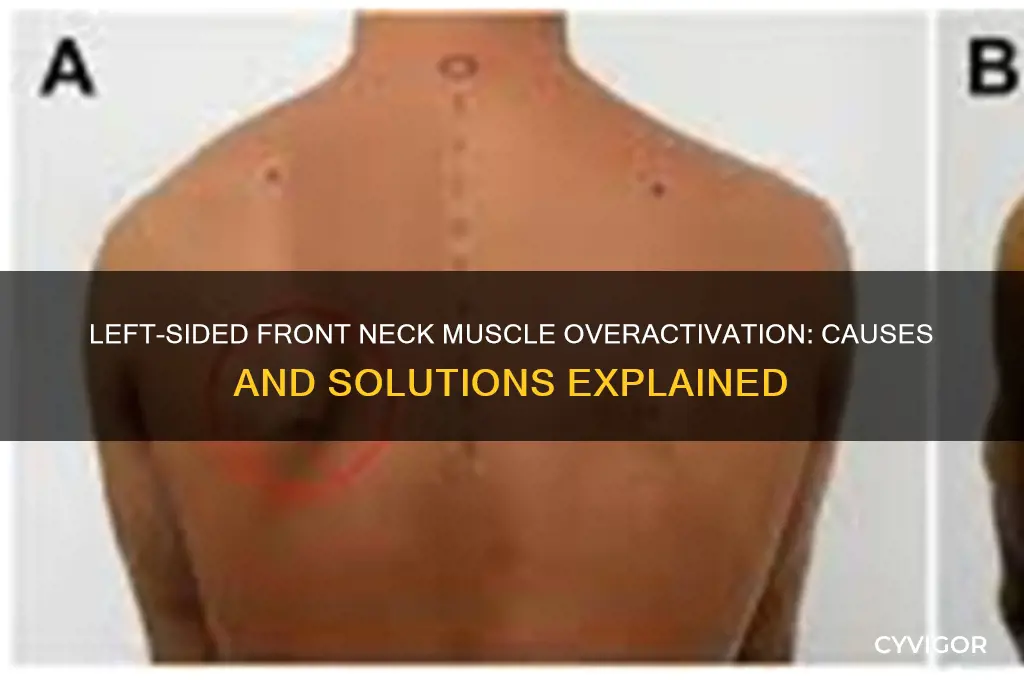 Left-Sided Front Neck Muscle Overactivation: Causes And Solutions ...