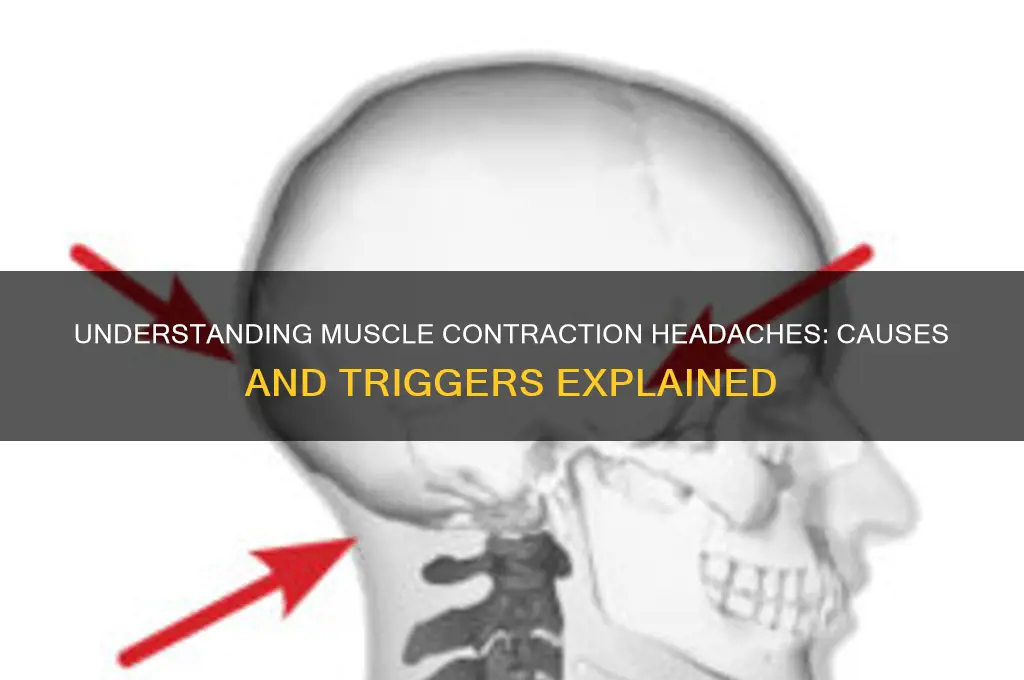 Understanding Muscle Contraction Headaches: Causes And Triggers ...