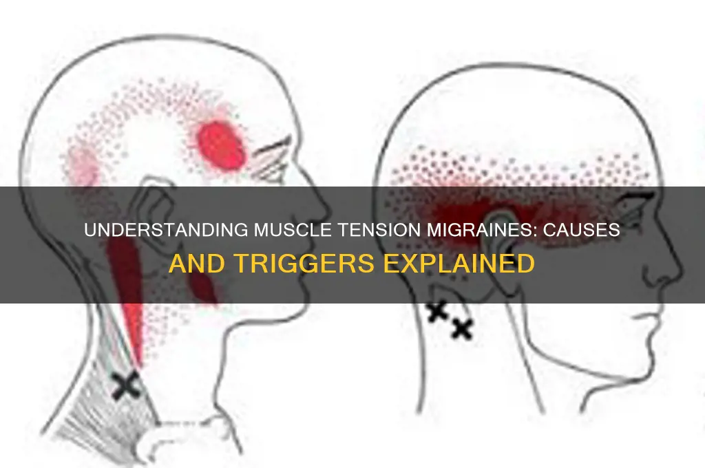 Understanding Muscle Tension Migraines: Causes And Triggers Explained ...