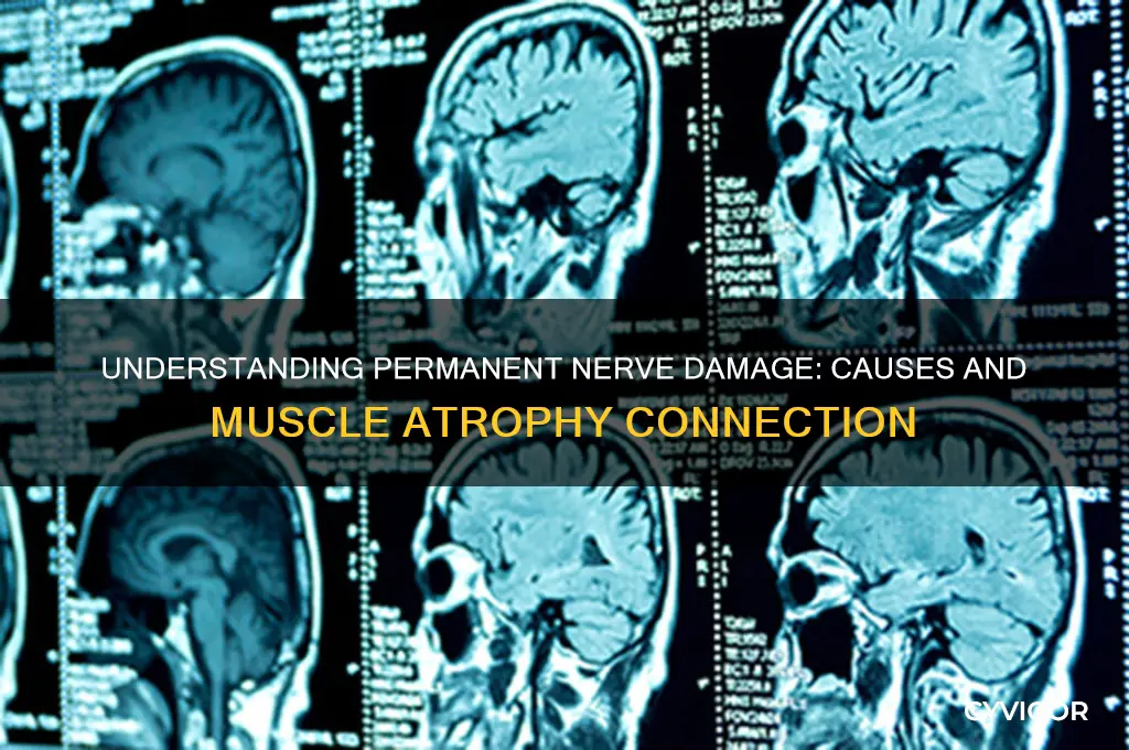 Understanding Permanent Nerve Damage: Causes And Muscle Atrophy ...