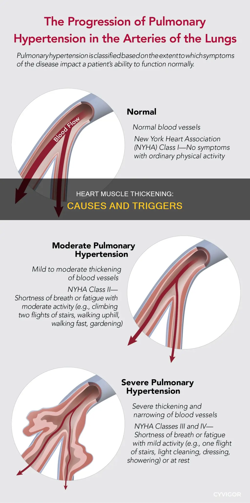 Heart Muscle Thickening: Causes And Triggers | CyVigor
