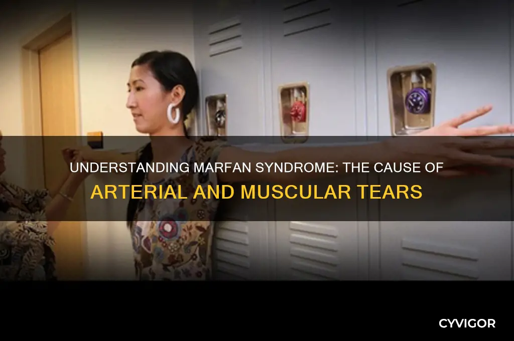 Understanding Marfan Syndrome: The Cause Of Arterial And Muscular Tears ...