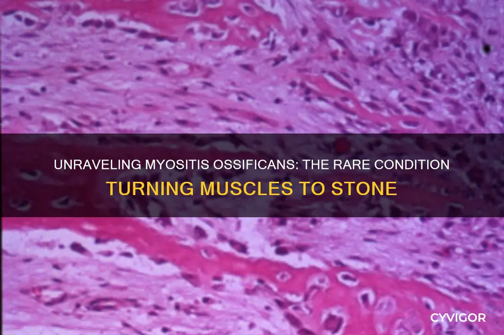 Unraveling Myositis Ossificans: The Rare Condition Turning Muscles To ...