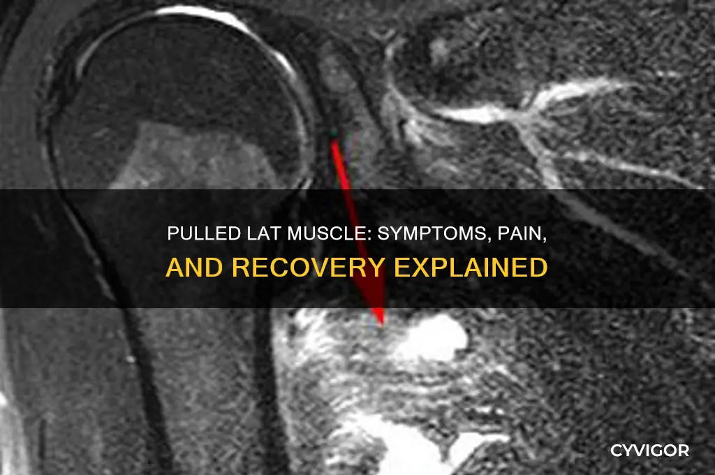 Pulled Lat Muscle: Symptoms, Pain, And Recovery Explained | CyVigor