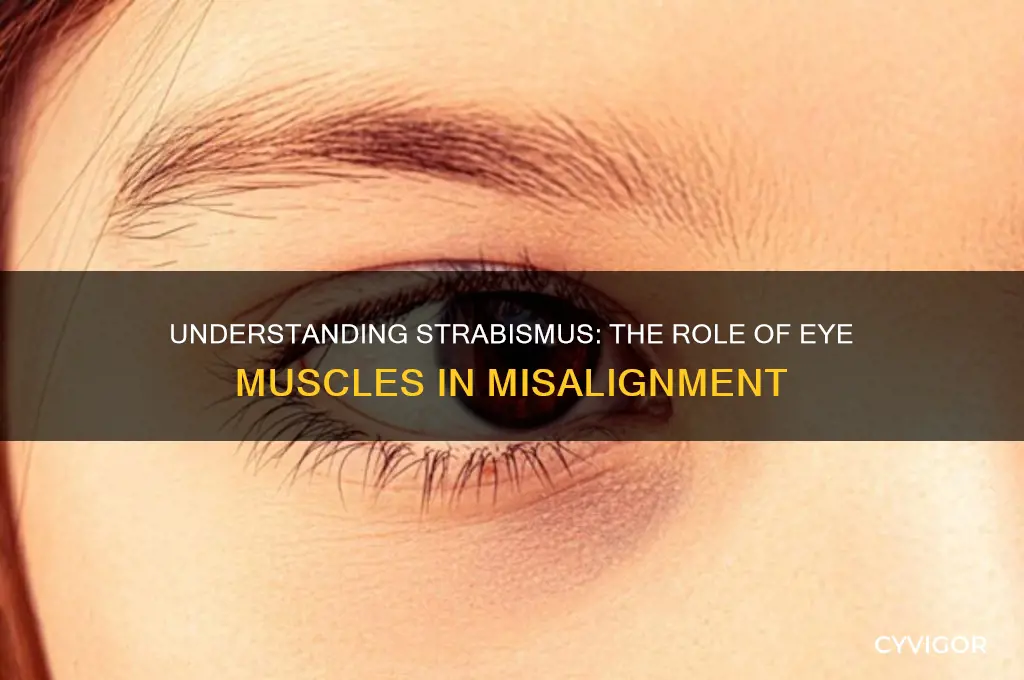 Understanding Strabismus: The Role Of Eye Muscles In Misalignment | CyVigor
