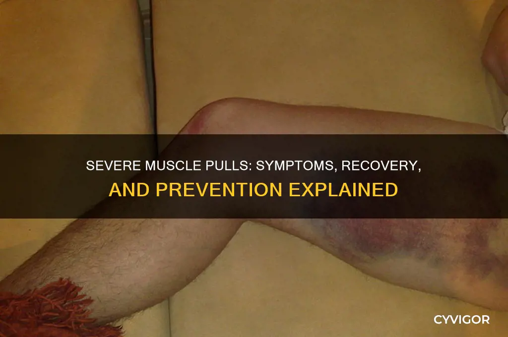 Severe Muscle Pulls: Symptoms, Recovery, And Prevention Explained | CyVigor