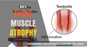 Understanding Flaccid Muscle Paralysis: Causes And Treatments | CyVigor