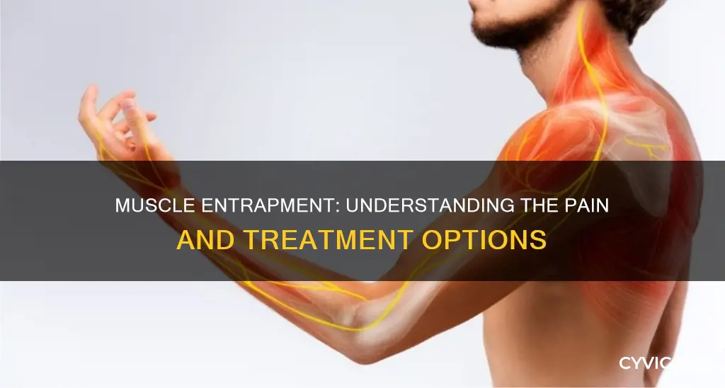 Muscle Entrapment: Understanding The Pain And Treatment Options | CyVigor