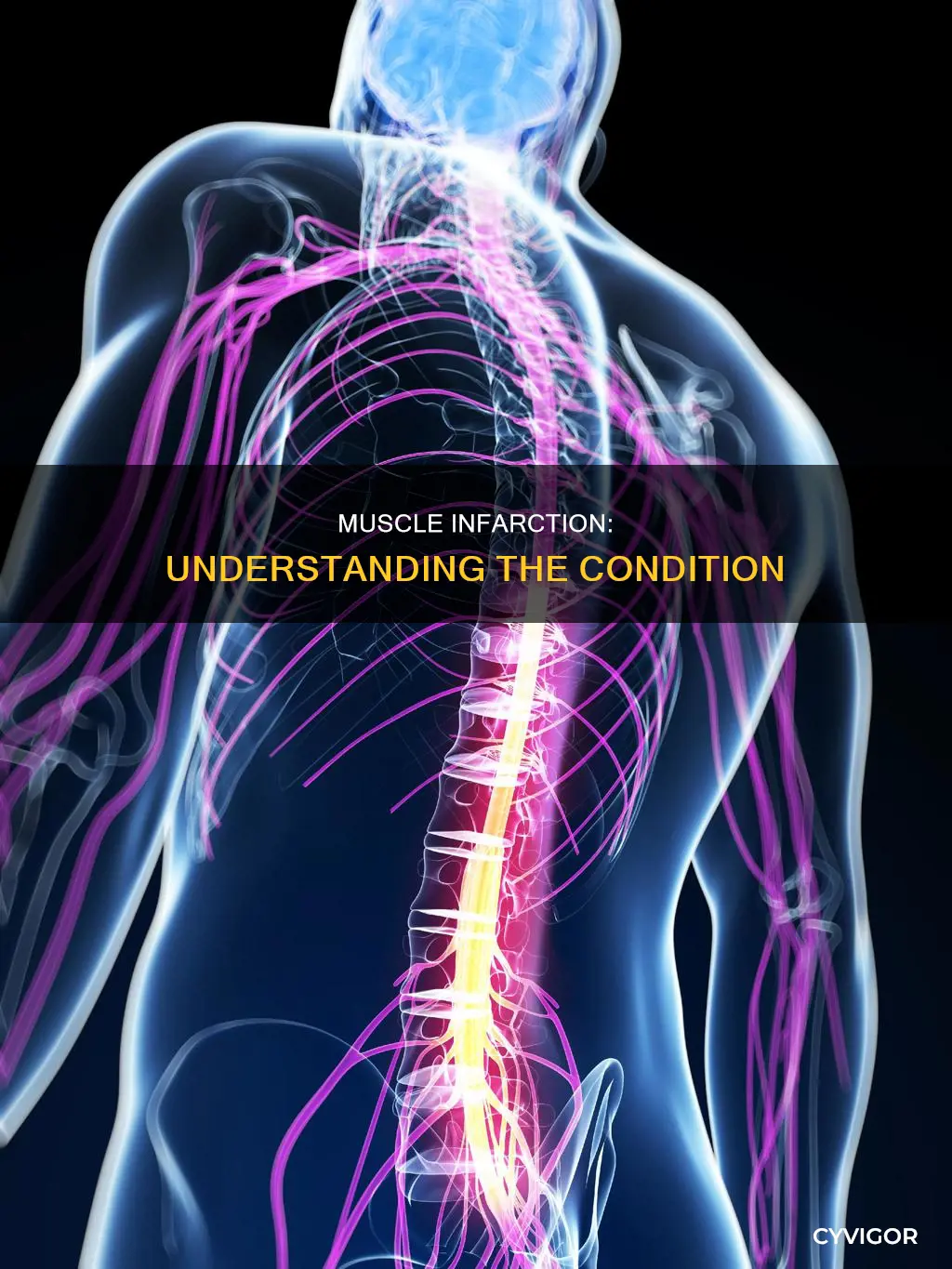 Muscle Infarction: Understanding The Condition | CyVigor