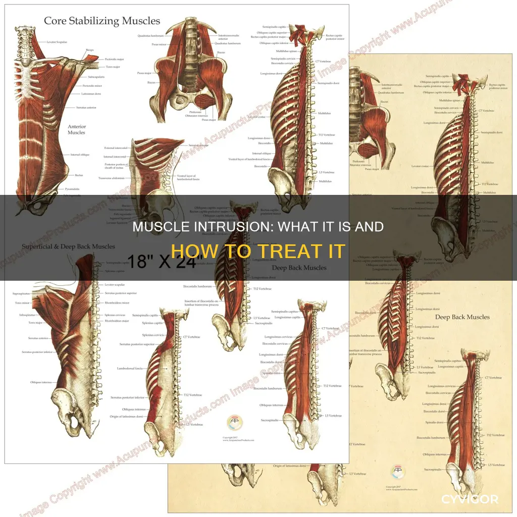 Muscle Intrusion: What It Is And How To Treat It | CyVigor