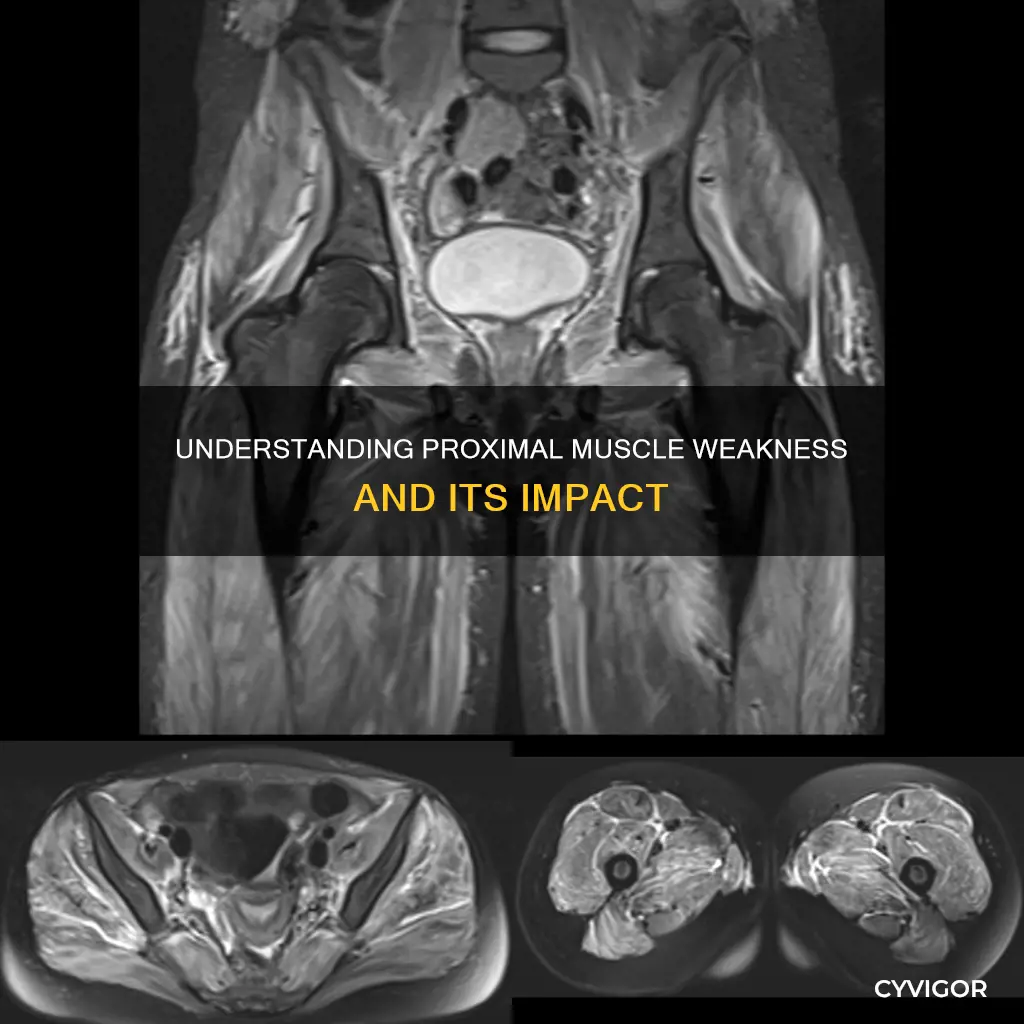 Understanding Proximal Muscle Weakness And Its Impact CyVigor Understanding Proximal Muscle Weakness And Its Impact CyVigor