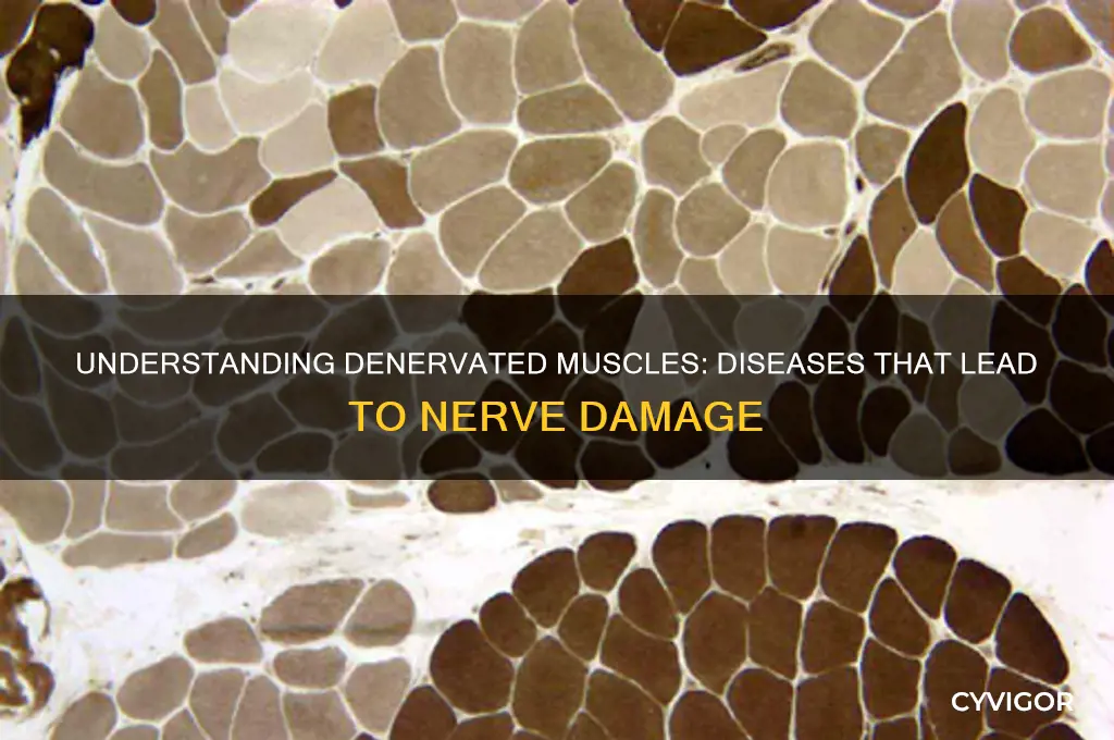 Understanding Denervated Muscles: Diseases That Lead To Nerve Damage ...
