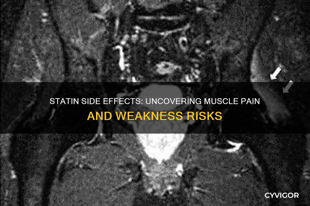 Statin Side Effects: Uncovering Muscle Pain And Weakness Risks | CyVigor