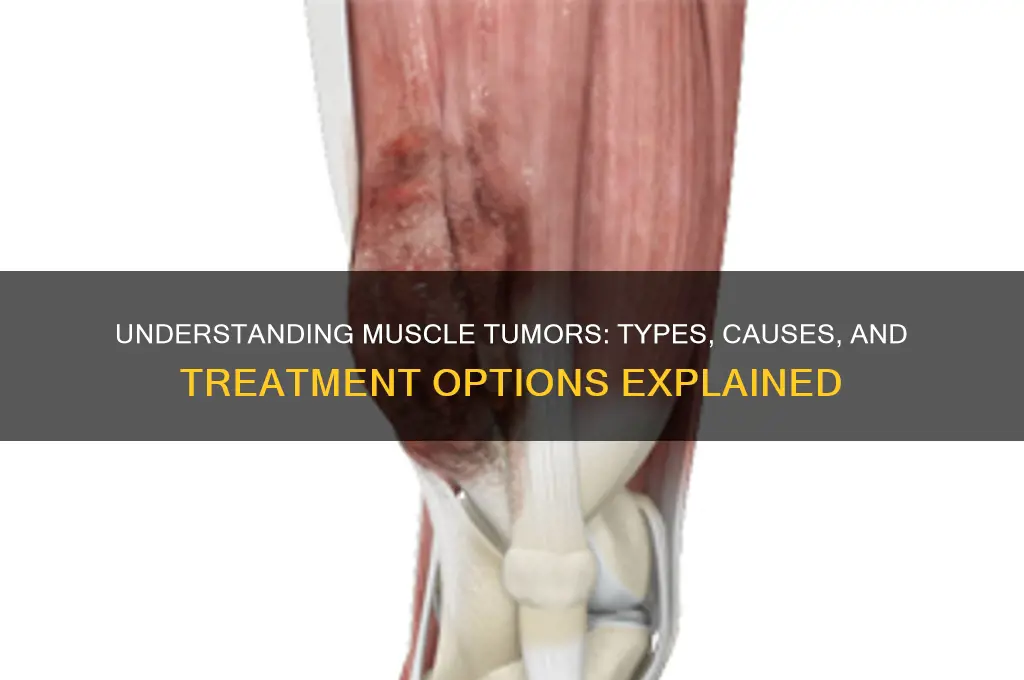Understanding Muscle Tumors: Types, Causes, And Treatment Options ...