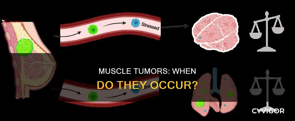 Muscle Tumors: When Do They Occur? | CyVigor