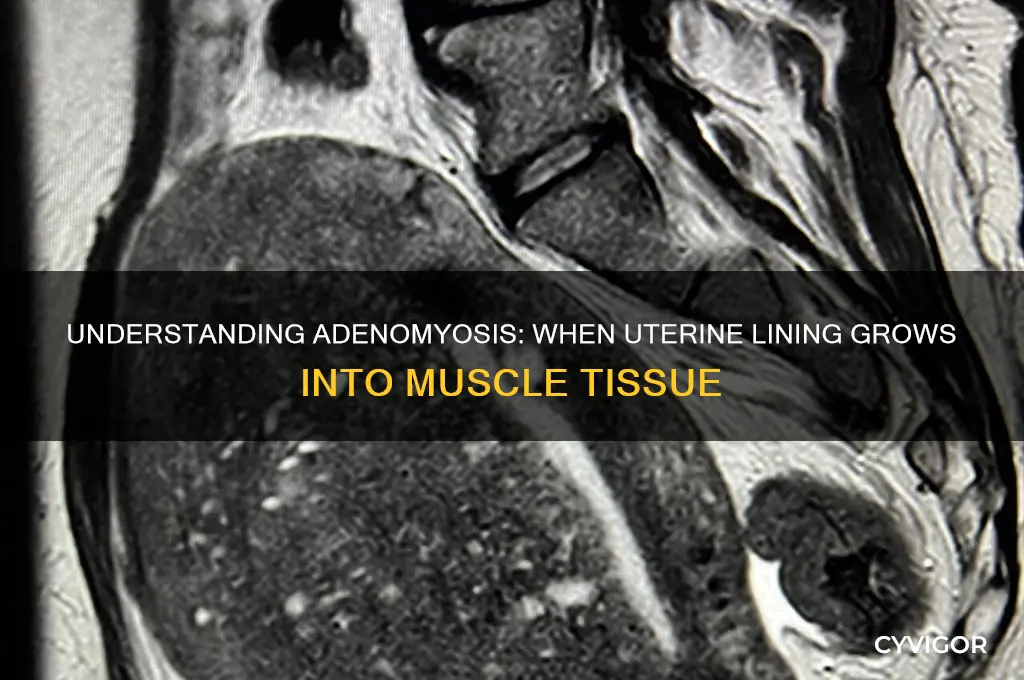 Understanding Adenomyosis: When Uterine Lining Grows Into Muscle Tissue ...
