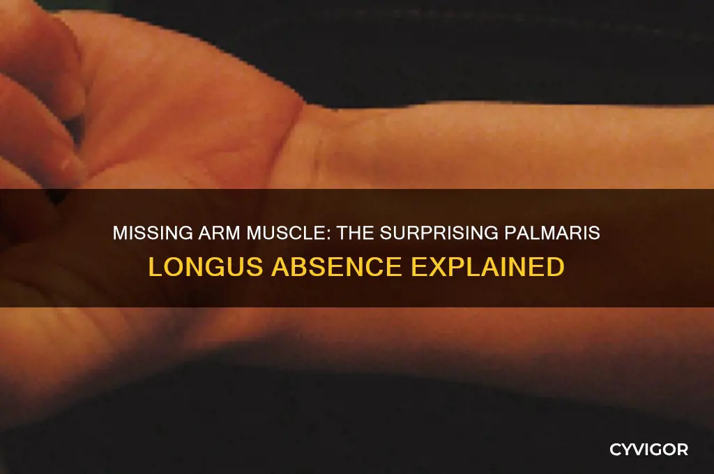 Missing Arm Muscle: The Surprising Palmaris Longus Absence Explained ...