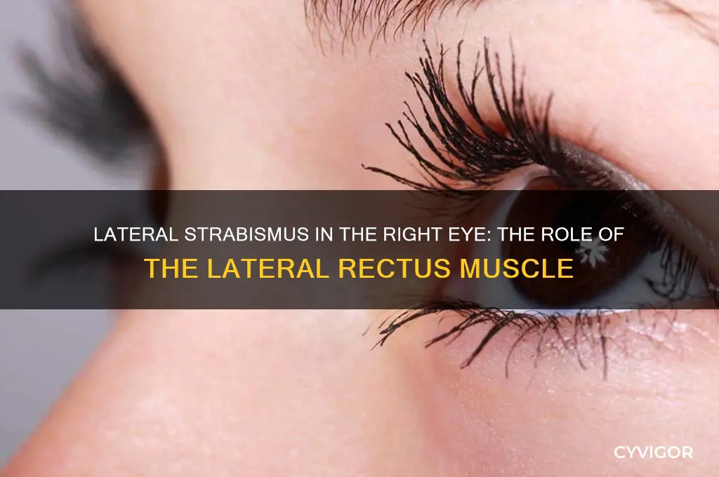 Lateral Strabismus In The Right Eye: The Role Of The Lateral Rectus ...