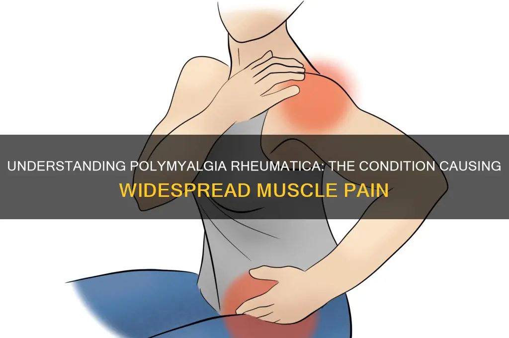 Understanding Polymyalgia Rheumatica: The Condition Causing Widespread ...