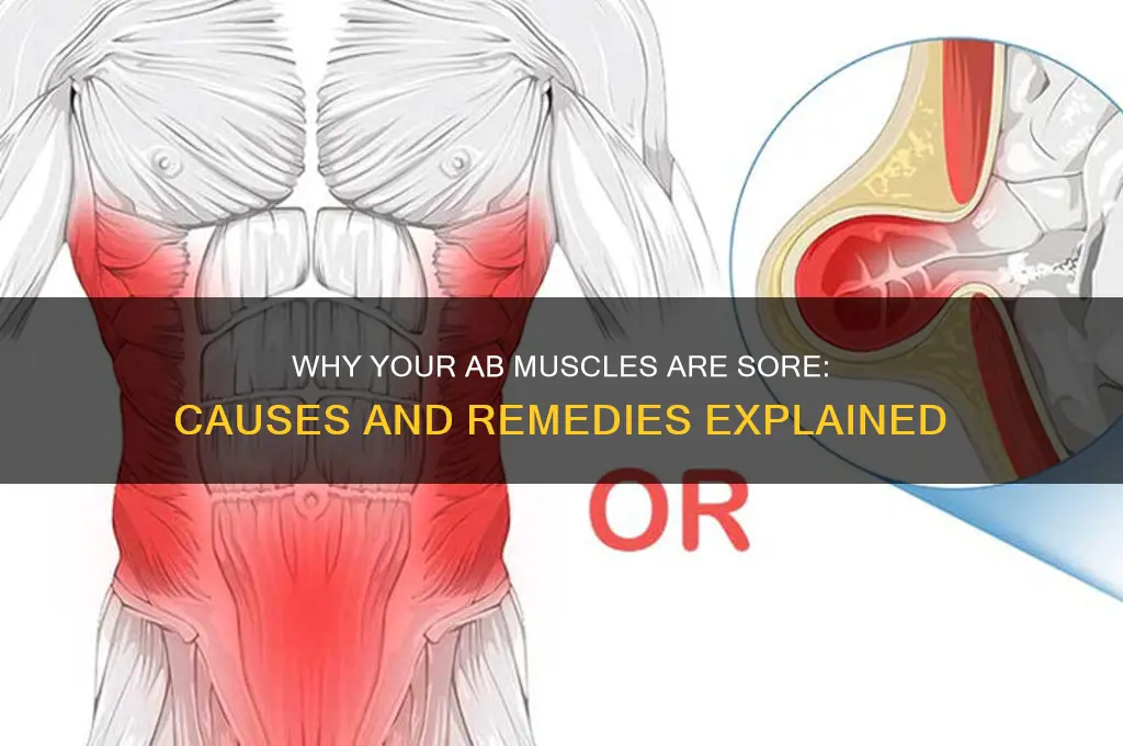 Why Your Ab Muscles Are Sore: Causes And Remedies Explained | CyVigor
