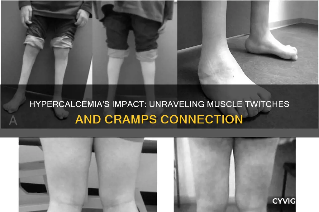 Hypercalcemia's Impact: Unraveling Muscle Twitches And Cramps ...