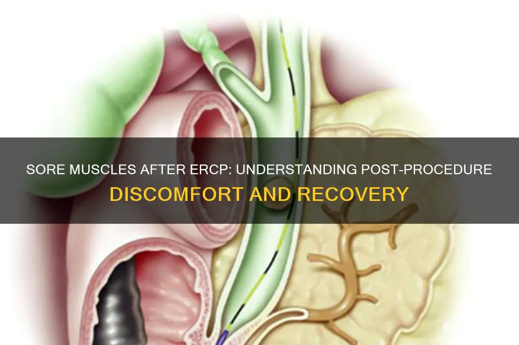 Sore Muscles After Ercp: Understanding Post-Procedure Discomfort And ...