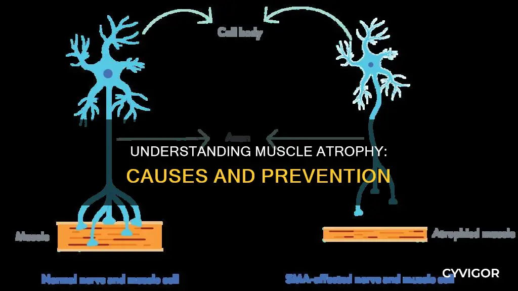 Understanding Muscle Atrophy: Causes And Prevention | CyVigor