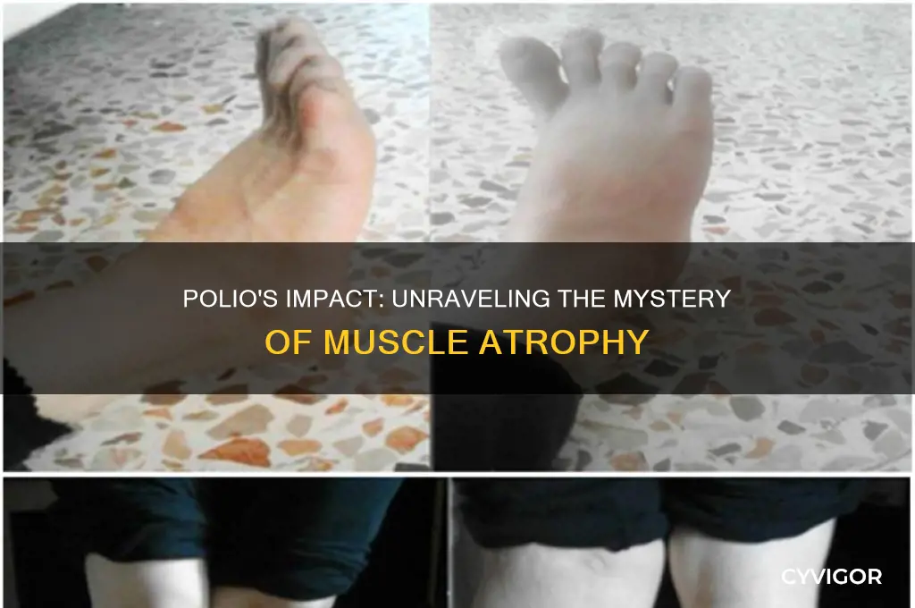 Polio's Impact: Unraveling The Mystery Of Muscle Atrophy | CyVigor