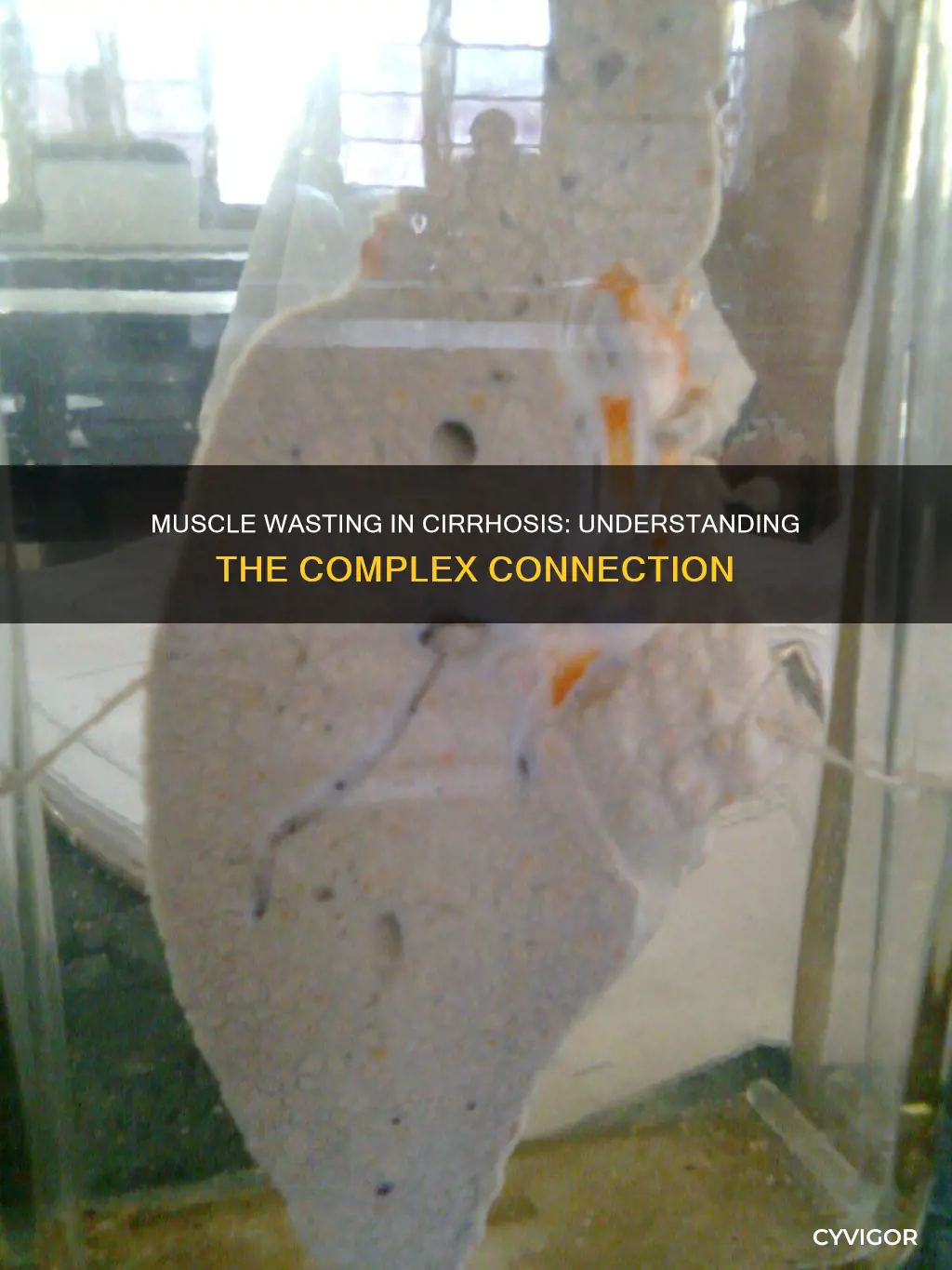 Muscle Wasting In Cirrhosis: Understanding The Complex Connection | CyVigor