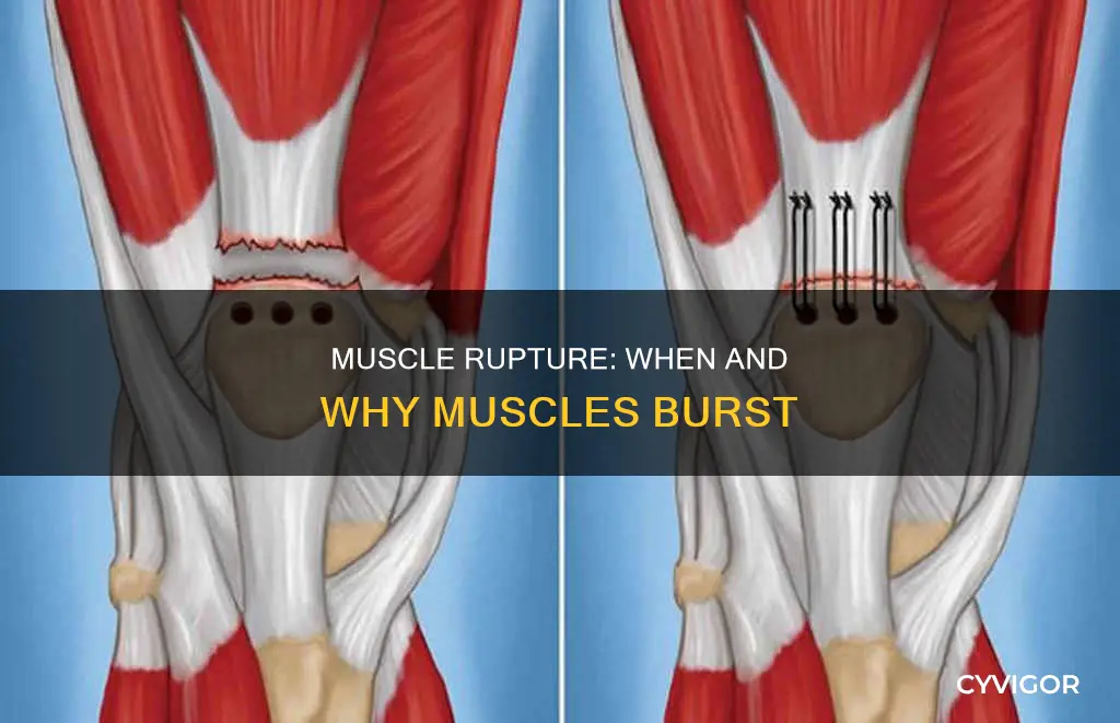 Muscle Rupture: When And Why Muscles Burst | CyVigor