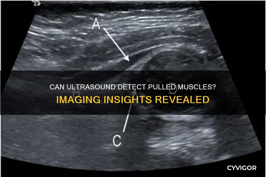 Can Ultrasound Detect Pulled Muscles? Imaging Insights Revealed | CyVigor