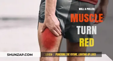 Understanding Muscle Pops: Causes, Risks, And When To Seek Help | CyVigor