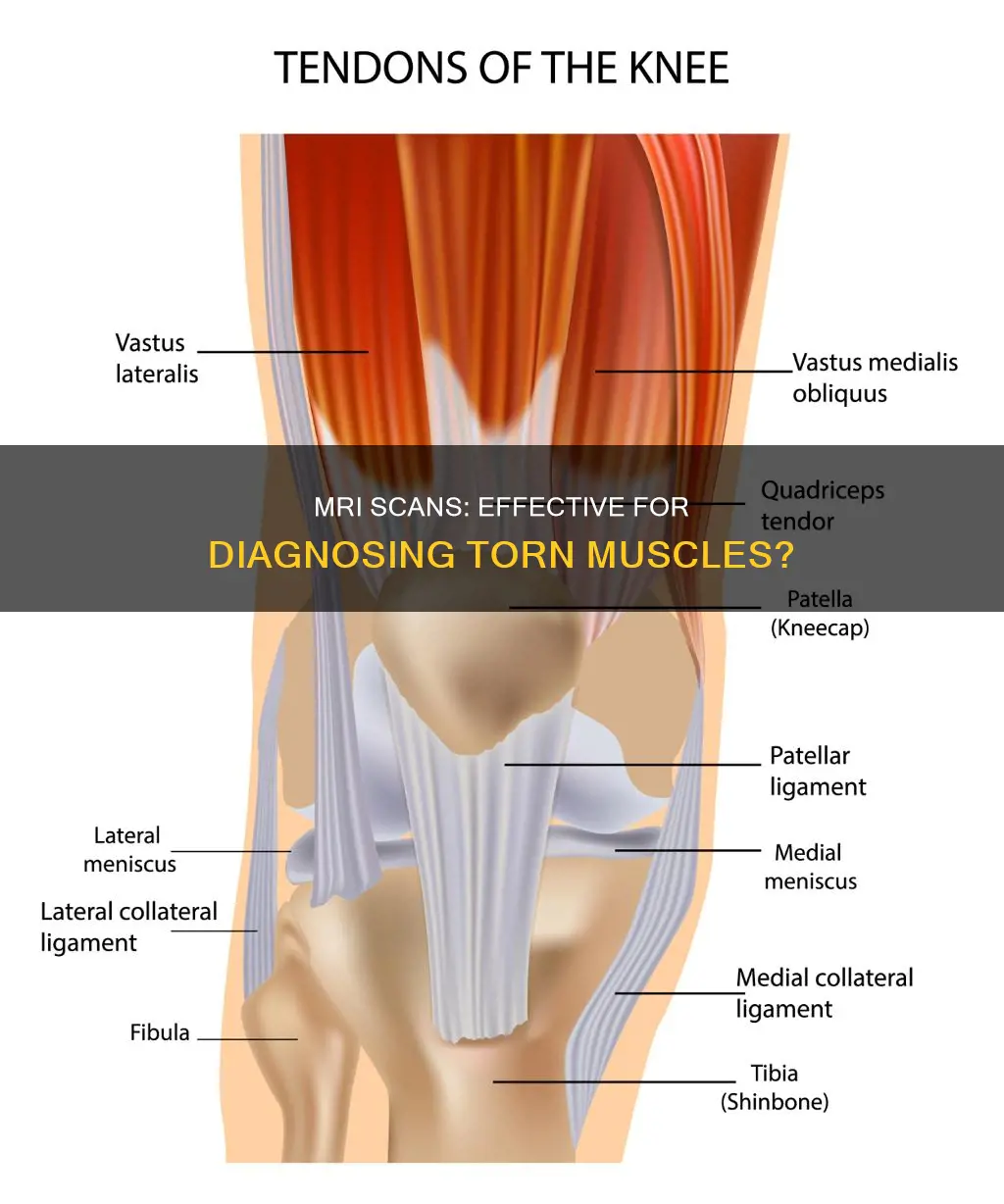 Mri Scans: Effective For Diagnosing Torn Muscles? | CyVigor