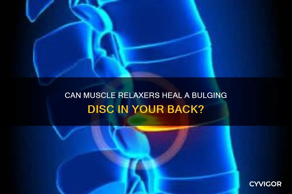 Can Muscle Relaxers Heal A Bulging Disc In Your Back? | CyVigor